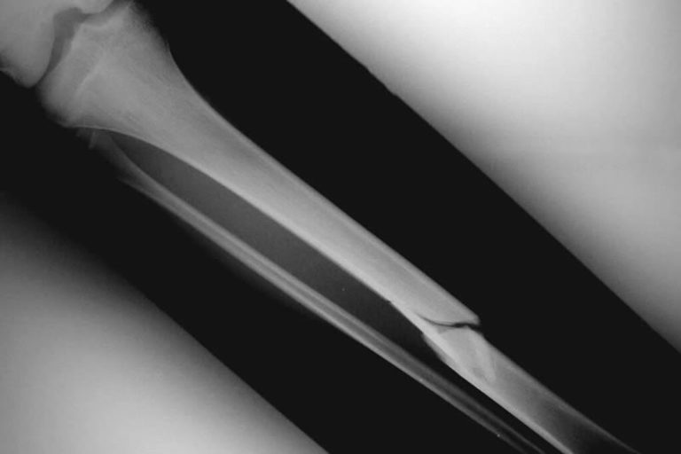 Fractura de Tibia ¿Cuánto tiempo tarda en sanar? - Dr. Brugiatti Ortopeda